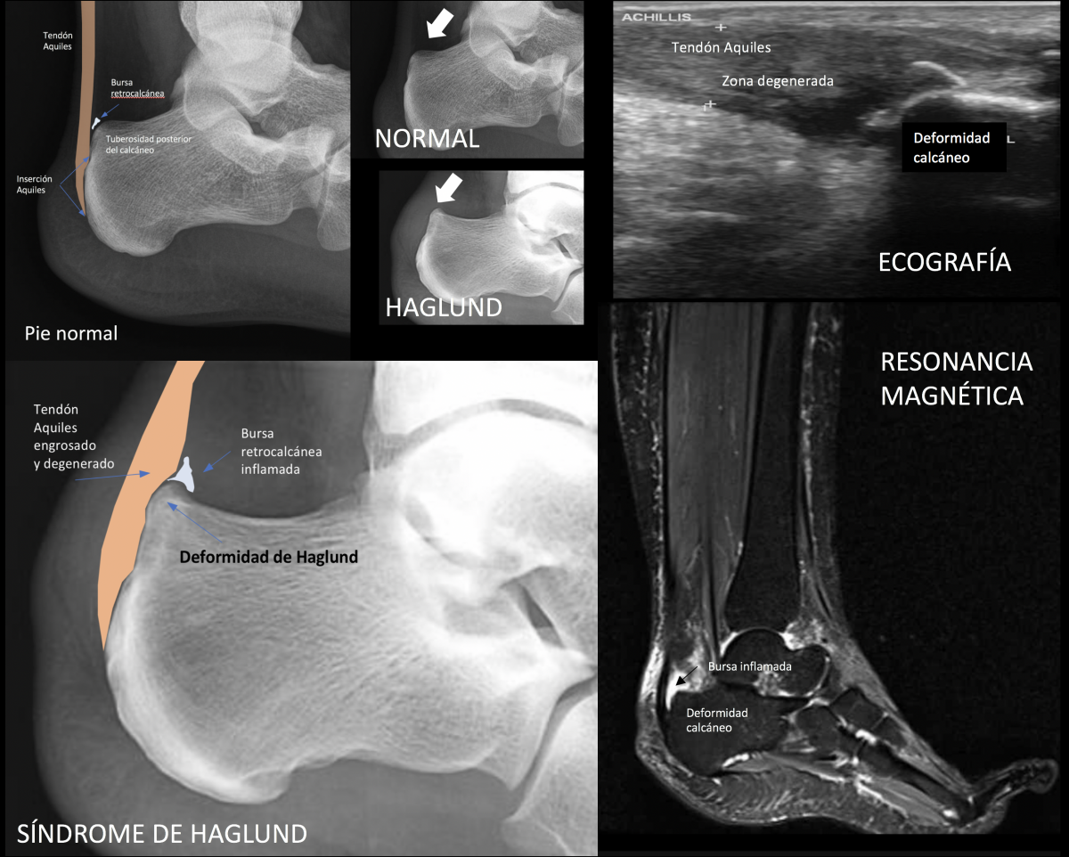 Traumatólogo para Síndrome de Haglund - CAMDE